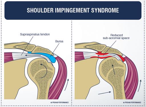 What's Wrong With My Shoulder? - Symmetry Physical Therapy